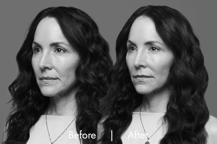 RHA Fillers in Mullica Hill, NJ | Malik Medical Aesthetics